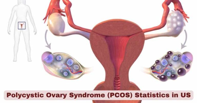 Polycystic Ovary Syndrome (PCOS) Statistics in US 2026 | Key Facts ...