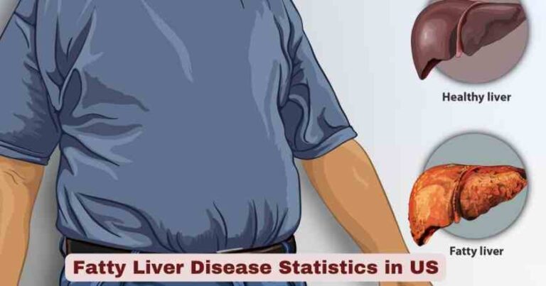 Fatty Liver Disease Statistics in US 2026 | Symptoms & Prevention - The ...